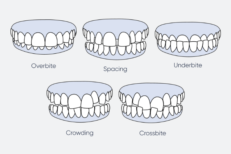 Malocclusion: Types, Causes & Treatment Options – Aligner32