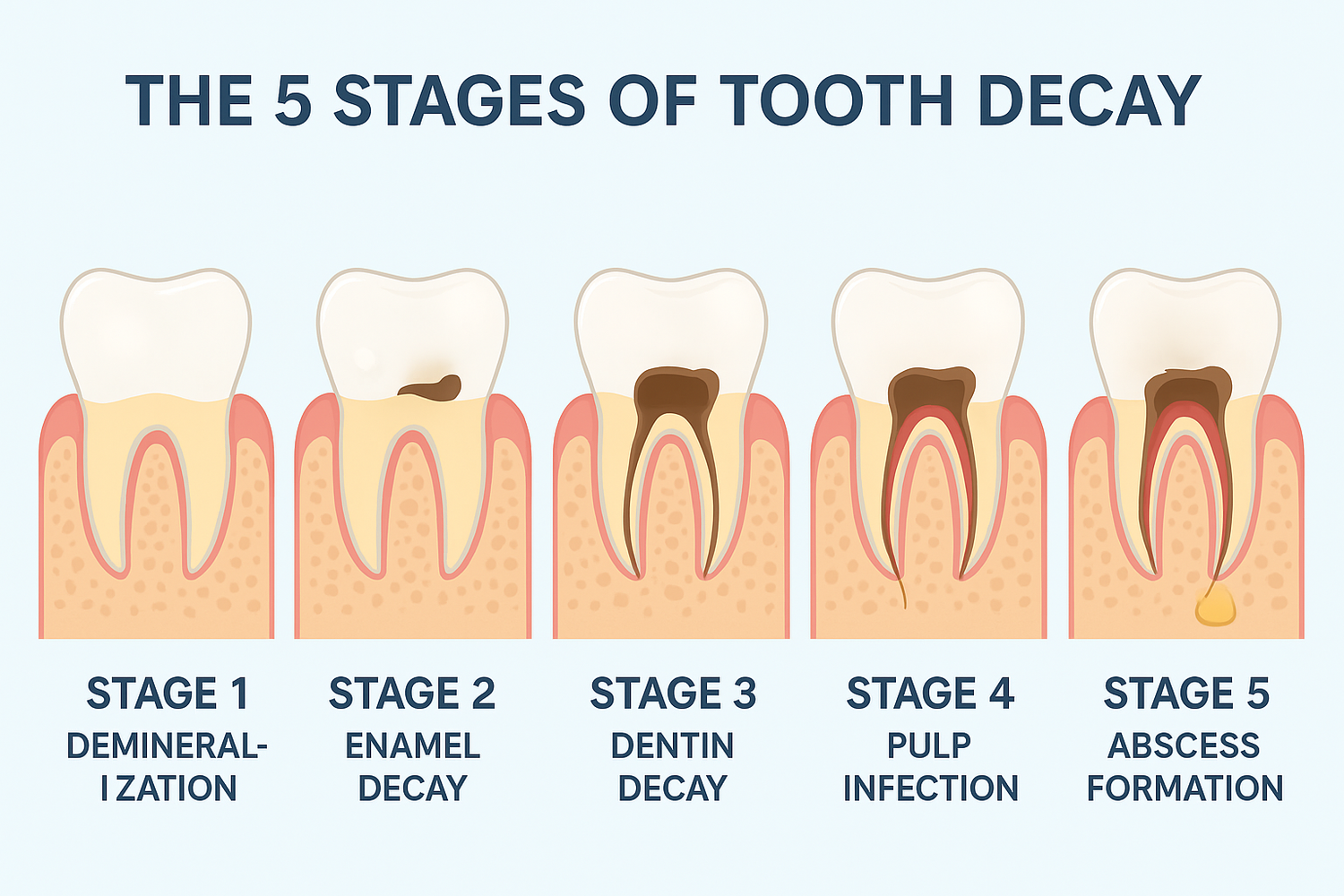 The 5 Stages of Tooth Decay and How to Stop Them – Aligner32